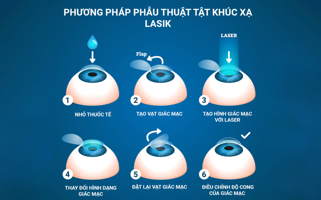 Quá trình thay đổi các phương pháp phẫu thuật tật khúc xạ bằng laser từ trước đến nay | Công ty ...