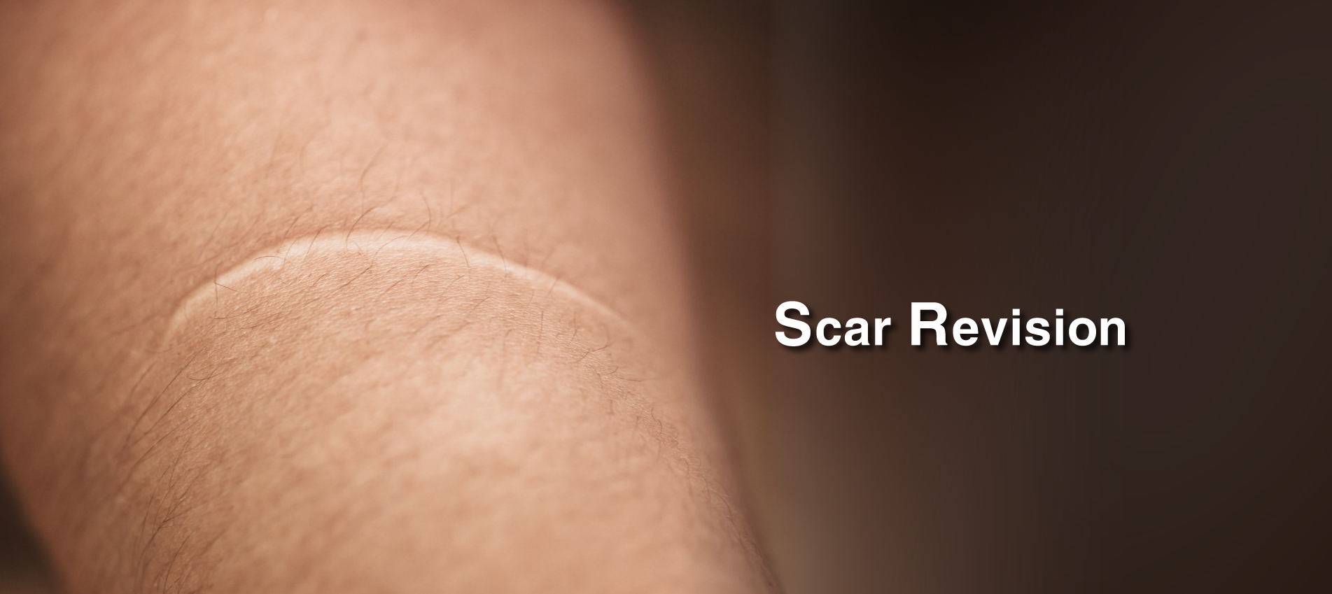 Scar Revision | Công ty TNHH TM & DV Việt Can